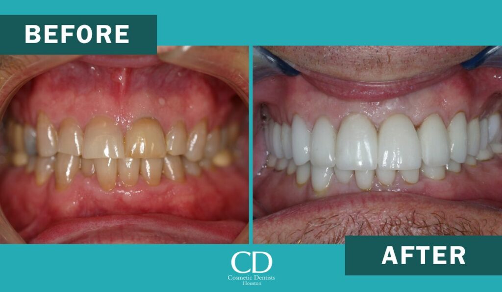 Tetracycline Teeth Discoloration- How Does it Happen? | Cosmetic ...