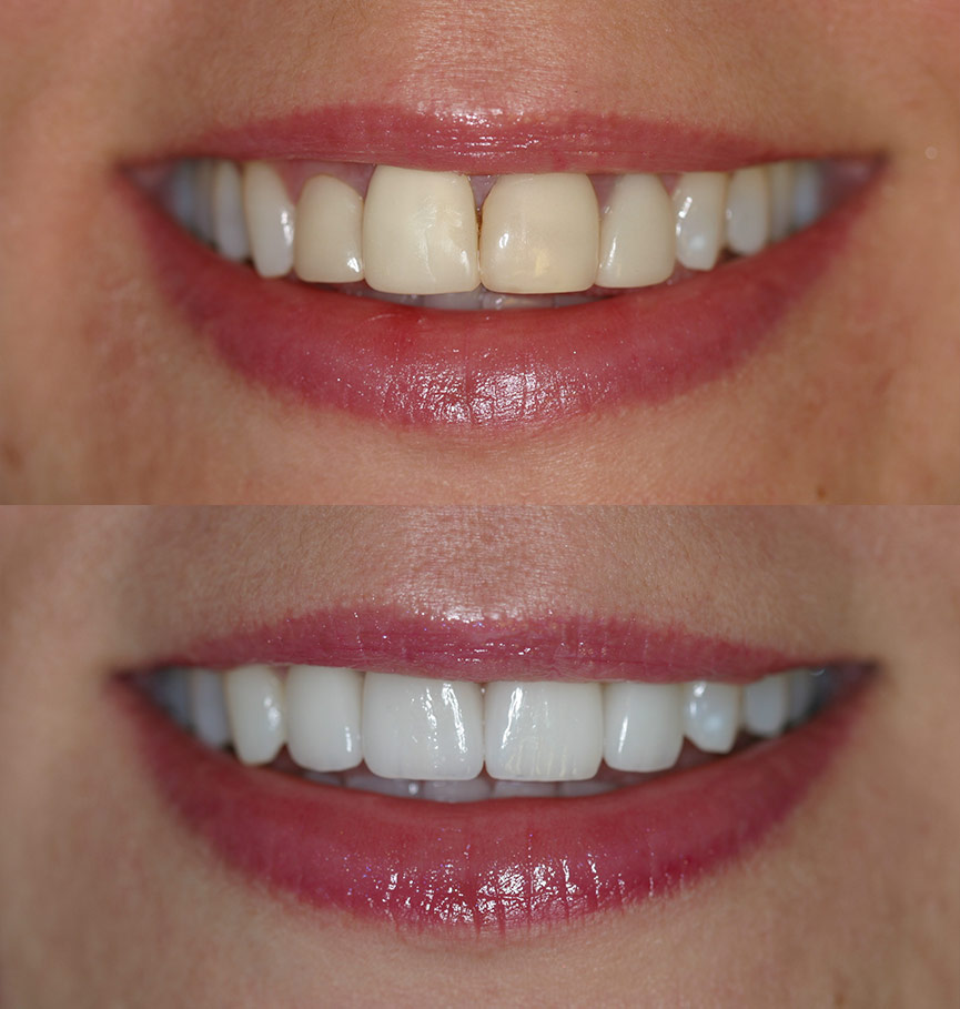 Before and After Photos | Cosmetic Dentists of Houston